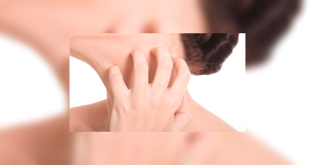 Dermografismo: ¿qué es y cómo se debe tratar?