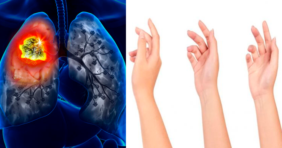 ¿Sabías que la posición de los dedos podría detectar el cáncer de pulmón?