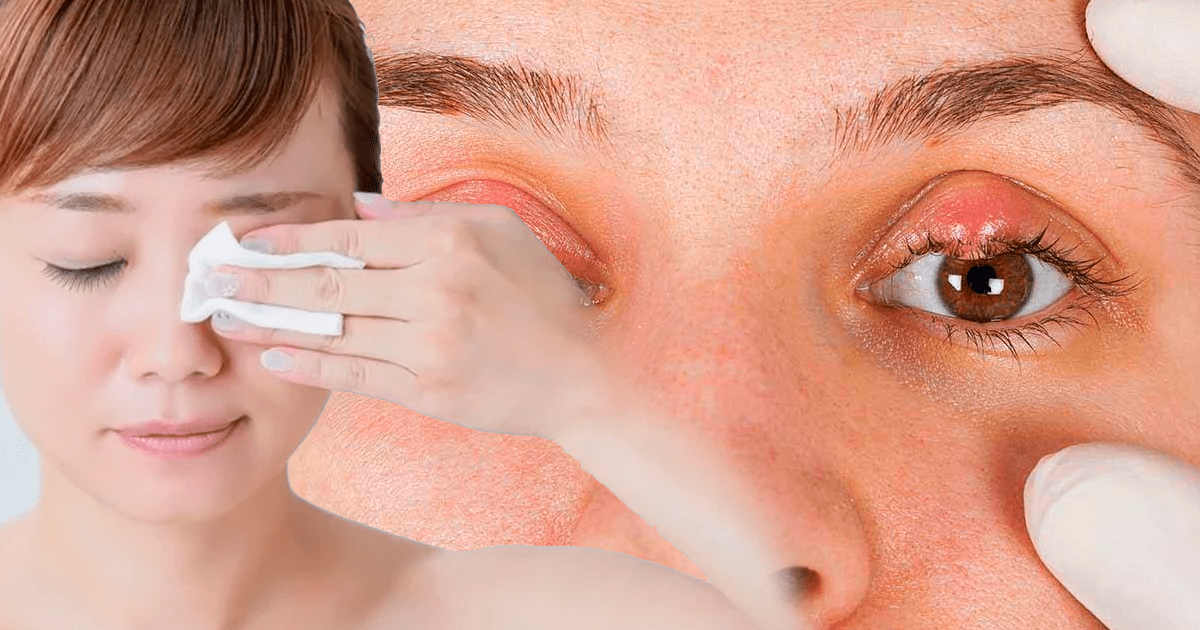 Orzuelo: ¿Por qué ocurre y cómo evitarlo? Conoce las razones detrás de ...