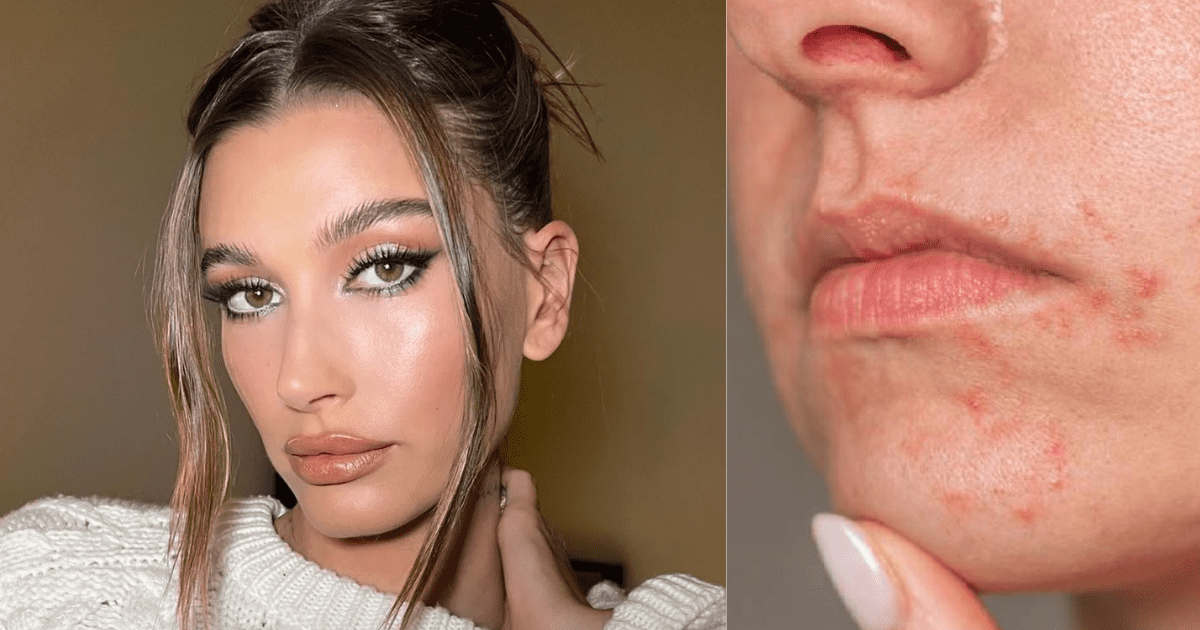 Hailey Bieber confiesa que tiene dermatitis perioral y revela sus ...