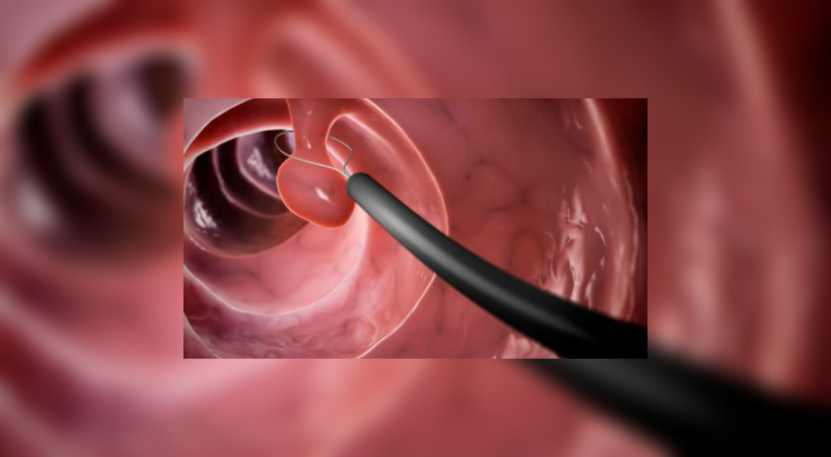 Los pólipos uterinos tienen baja probabilidad de convertirse en cáncer