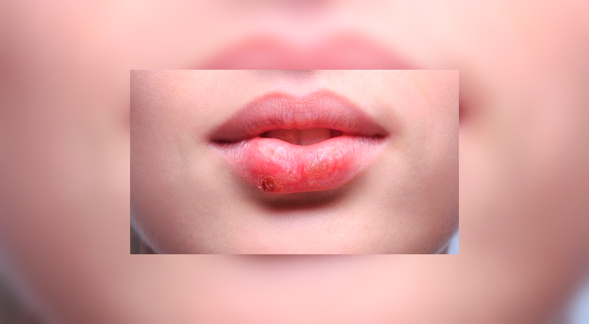 Herpes labial: 3 remedios caseros para aliviar la infección