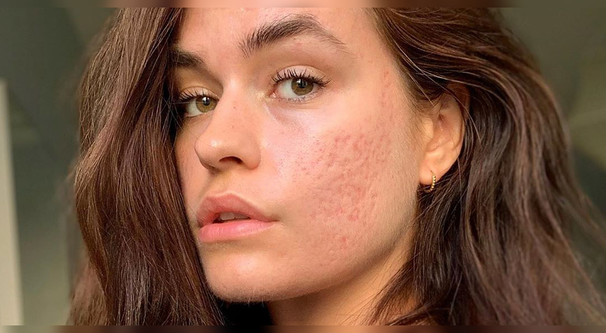 Mandamientos para aprender a aceptar tus 'imperfecciones' en la piel