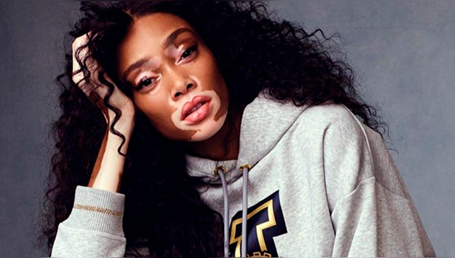 Vitíligo, la enfermedad que afecta a la modelo Winnie Harlow