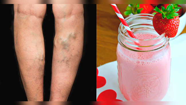 ¿Cómo detener la aparición de várices? Consíguelo con unos deliciosos ...